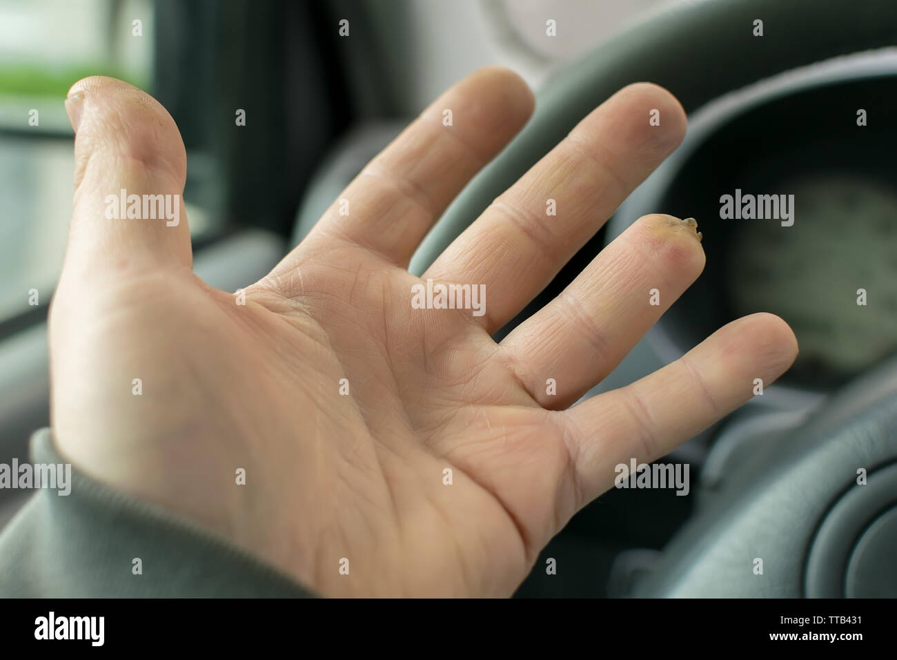 Ring finger injury hi-res stock photography and images - Alamy