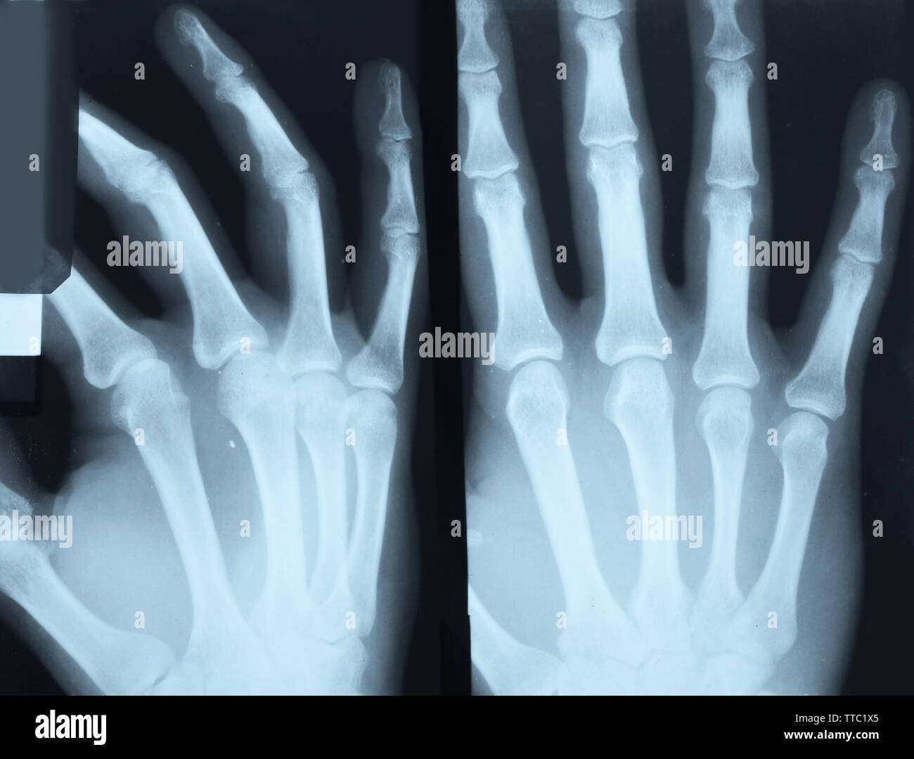 X-ray of the right hand in two projections on white background Stock ...