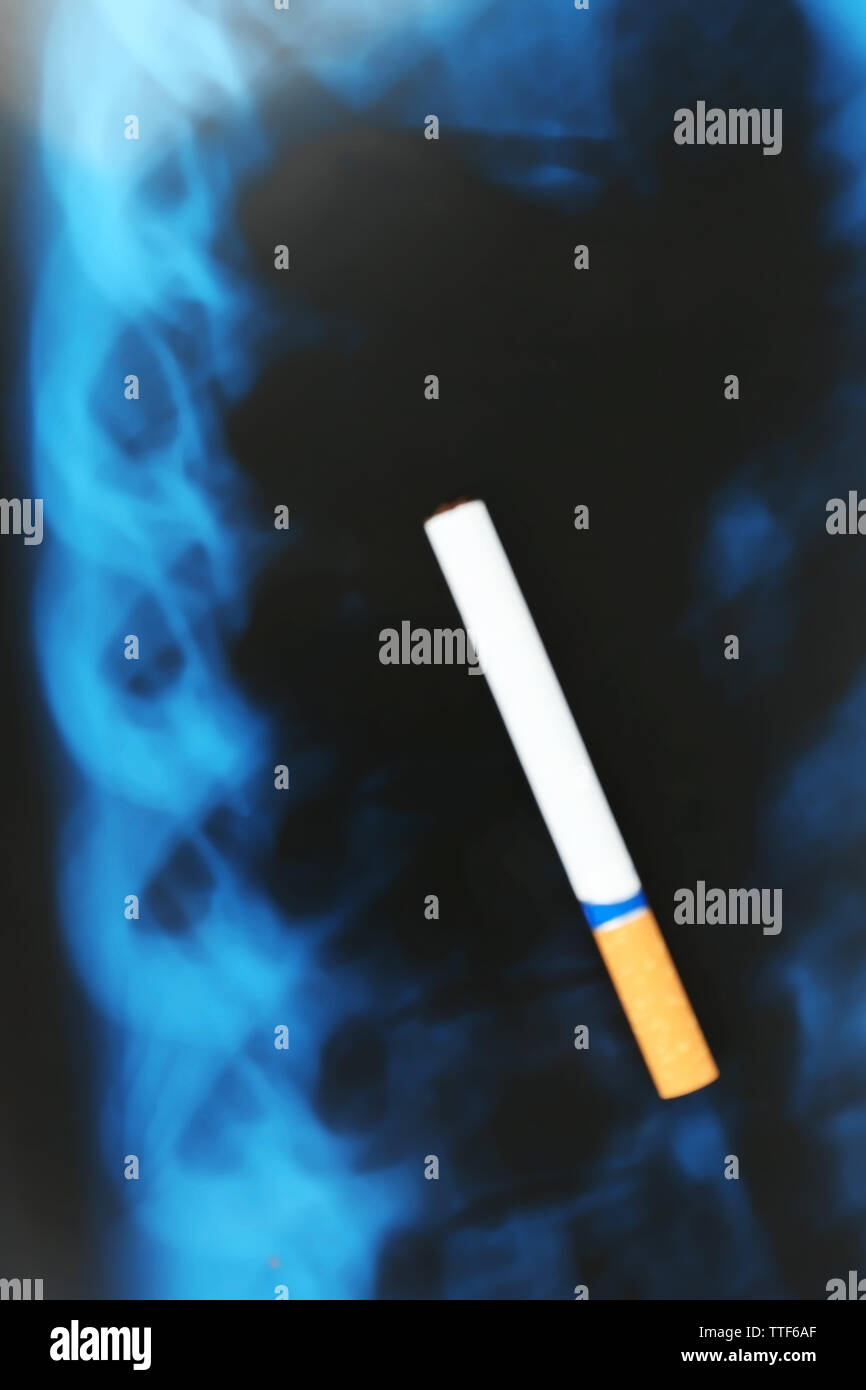 Cigarette on x-ray lung, close up Stock Photo - Alamy