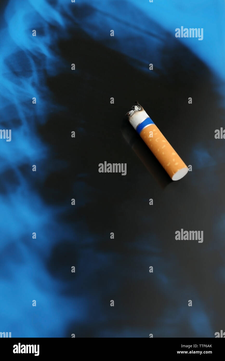 Cigarette on x-ray lung, close up Stock Photo - Alamy