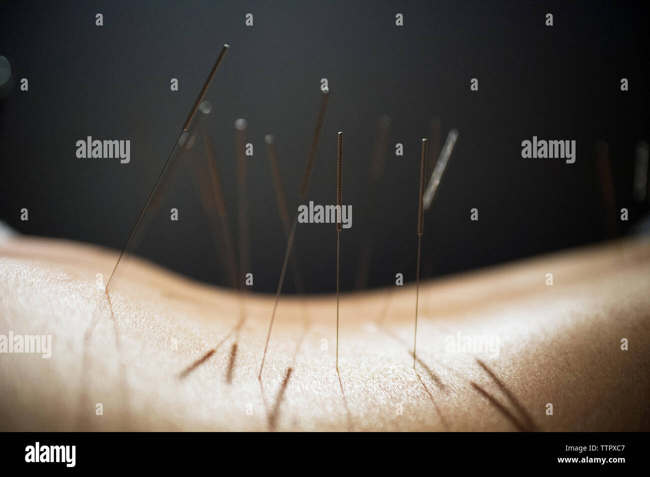 Acupuncture back needles hi-res stock photography and images - Alamy