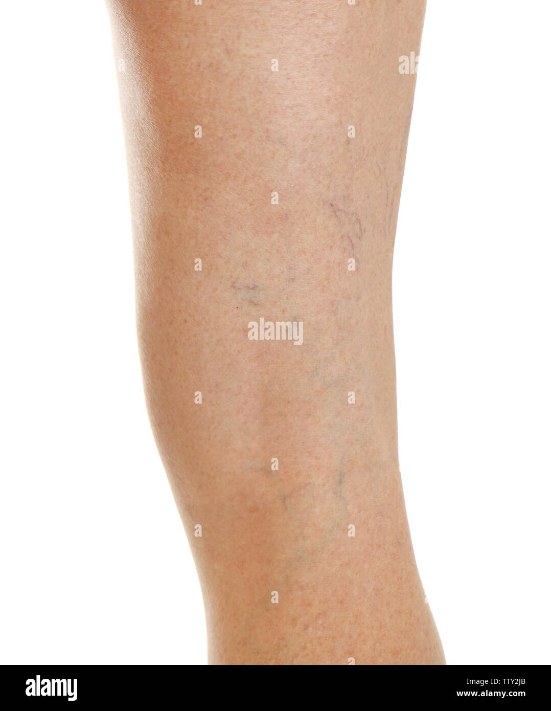 Lipodermatosclerosis hi-res stock photography and images - Alamy