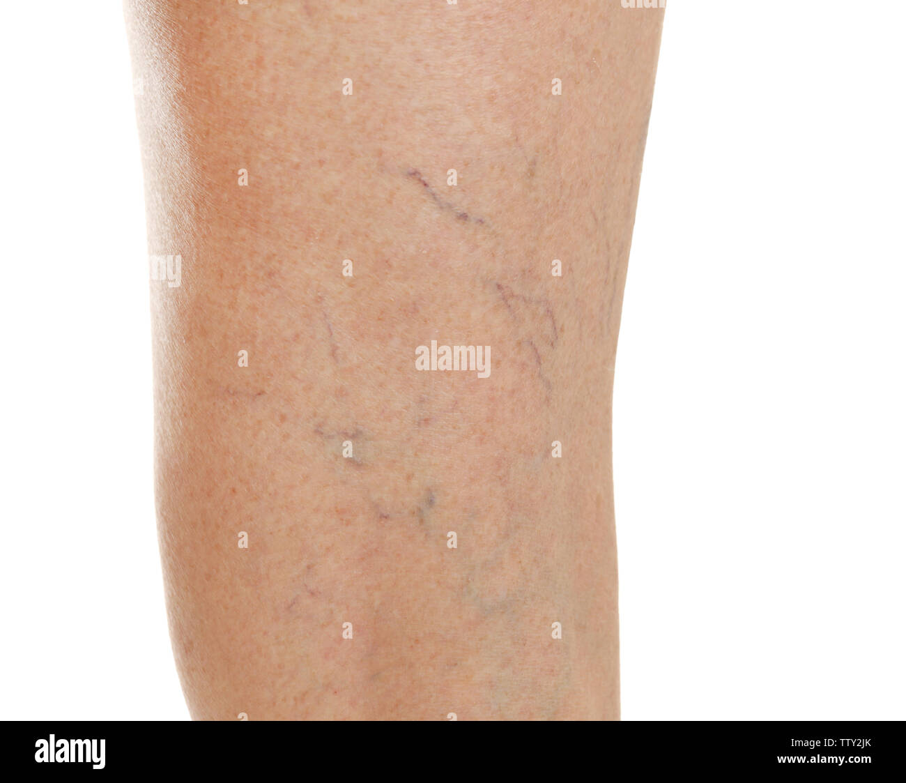 Lipodermatosclerosis hi-res stock photography and images - Alamy