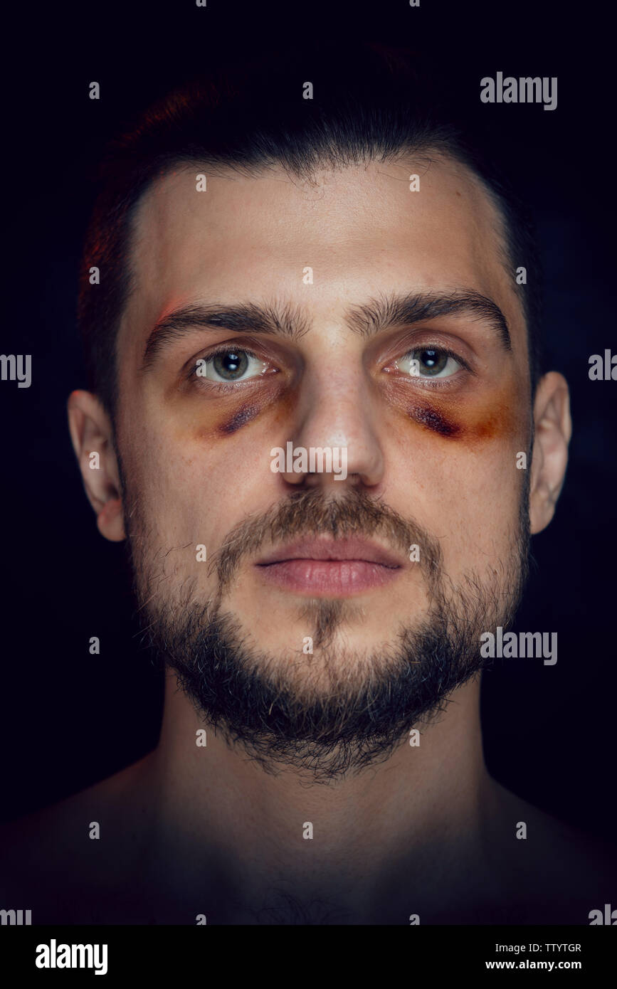 Face bruise hi-res stock photography and images - Alamy