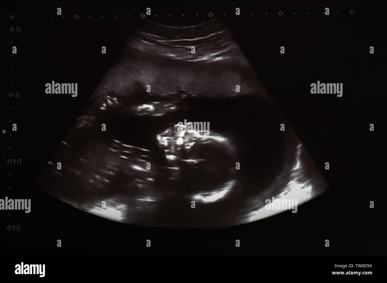 Ultrasound baby scan Stock Photo - Alamy