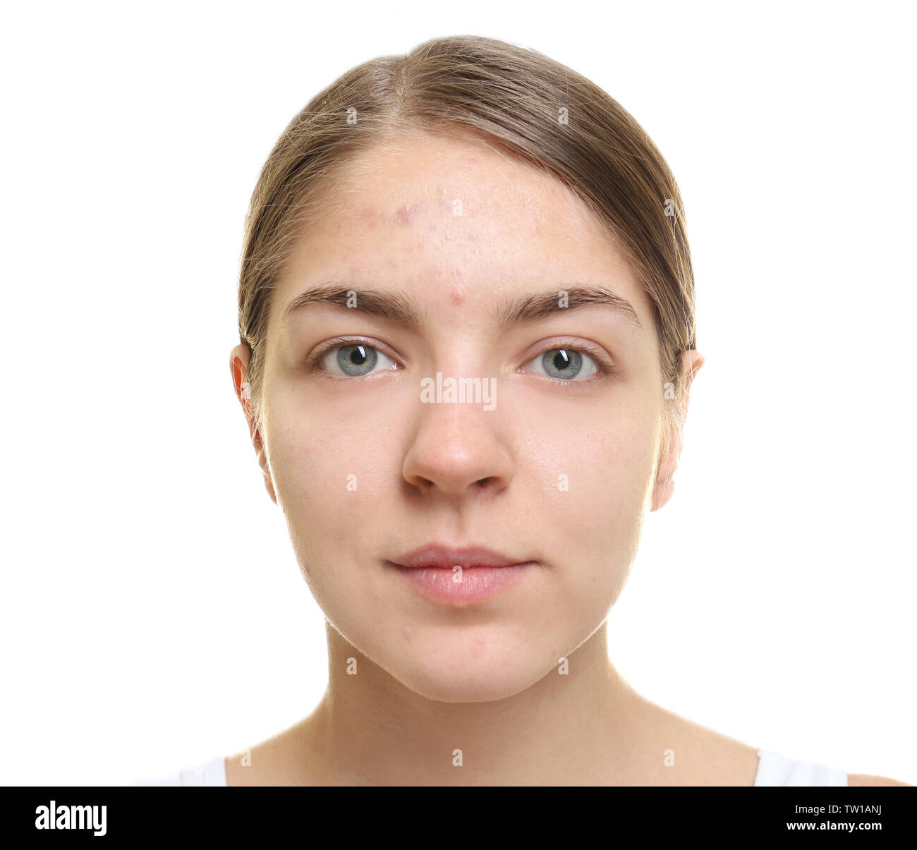 White spots on forehead hi-res stock photography and images - Alamy
