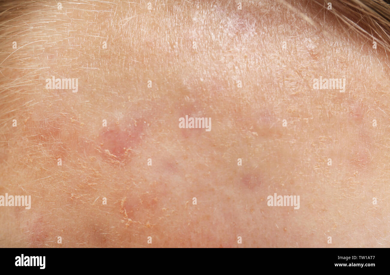 Human skin with acne, closeup Stock Photo - Alamy