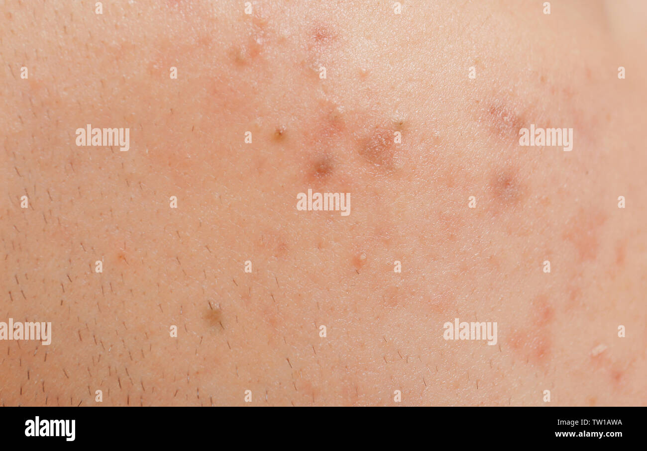 Acne Vulgaris Stock Photos & Acne Vulgaris Stock Images - Alamy
