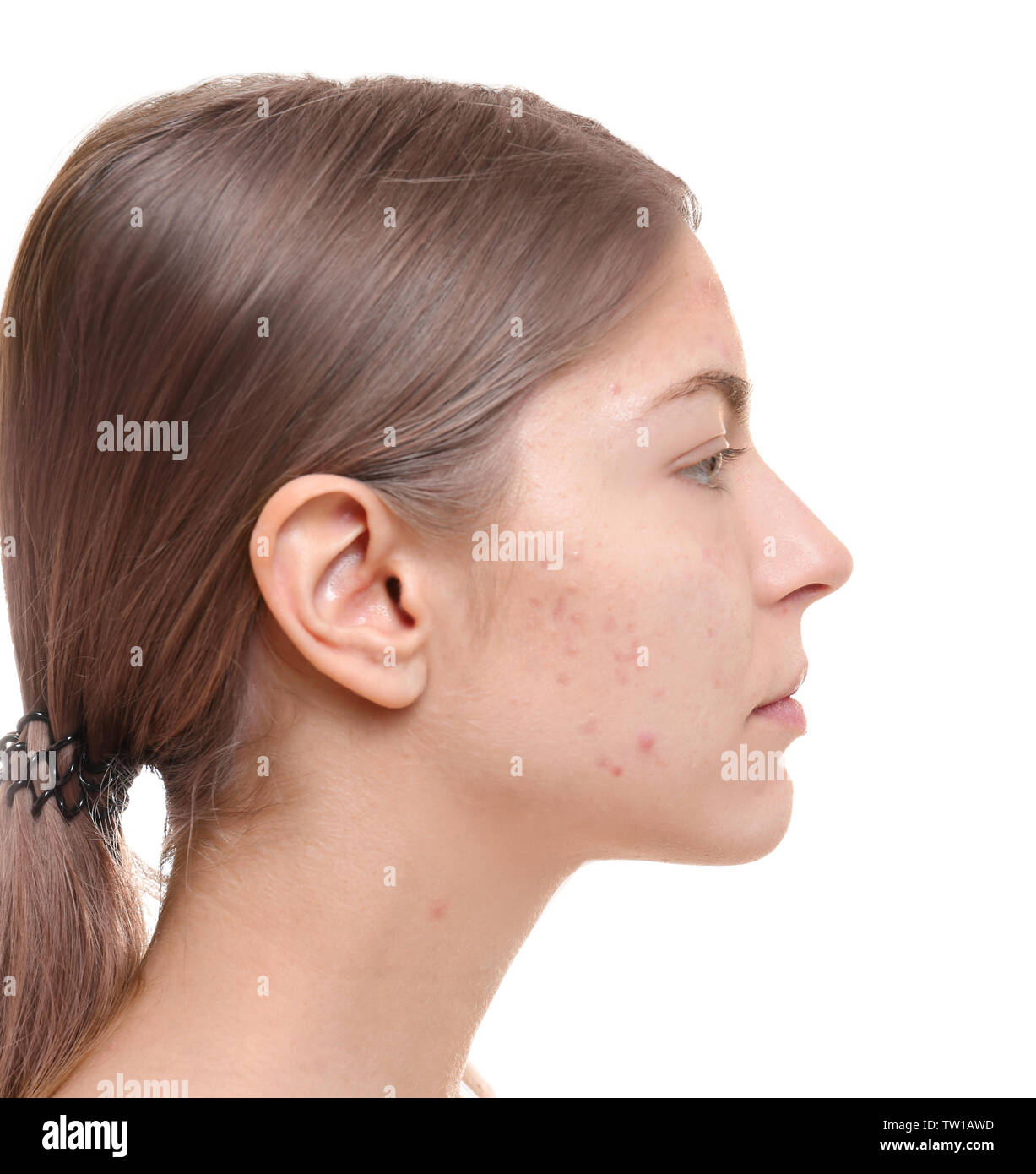 White spots on cheek hi-res stock photography and images - Alamy