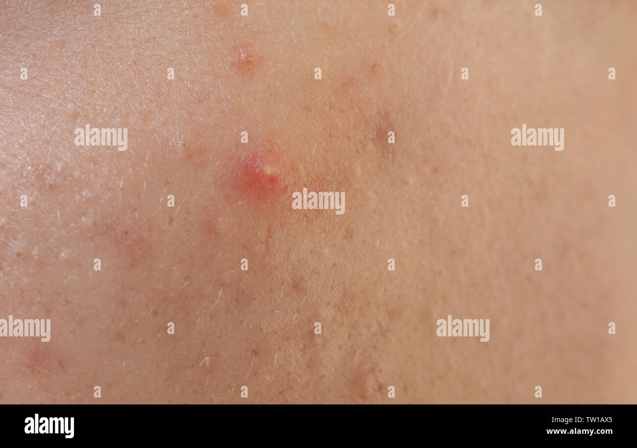 Human skin with acne, closeup Stock Photo - Alamy