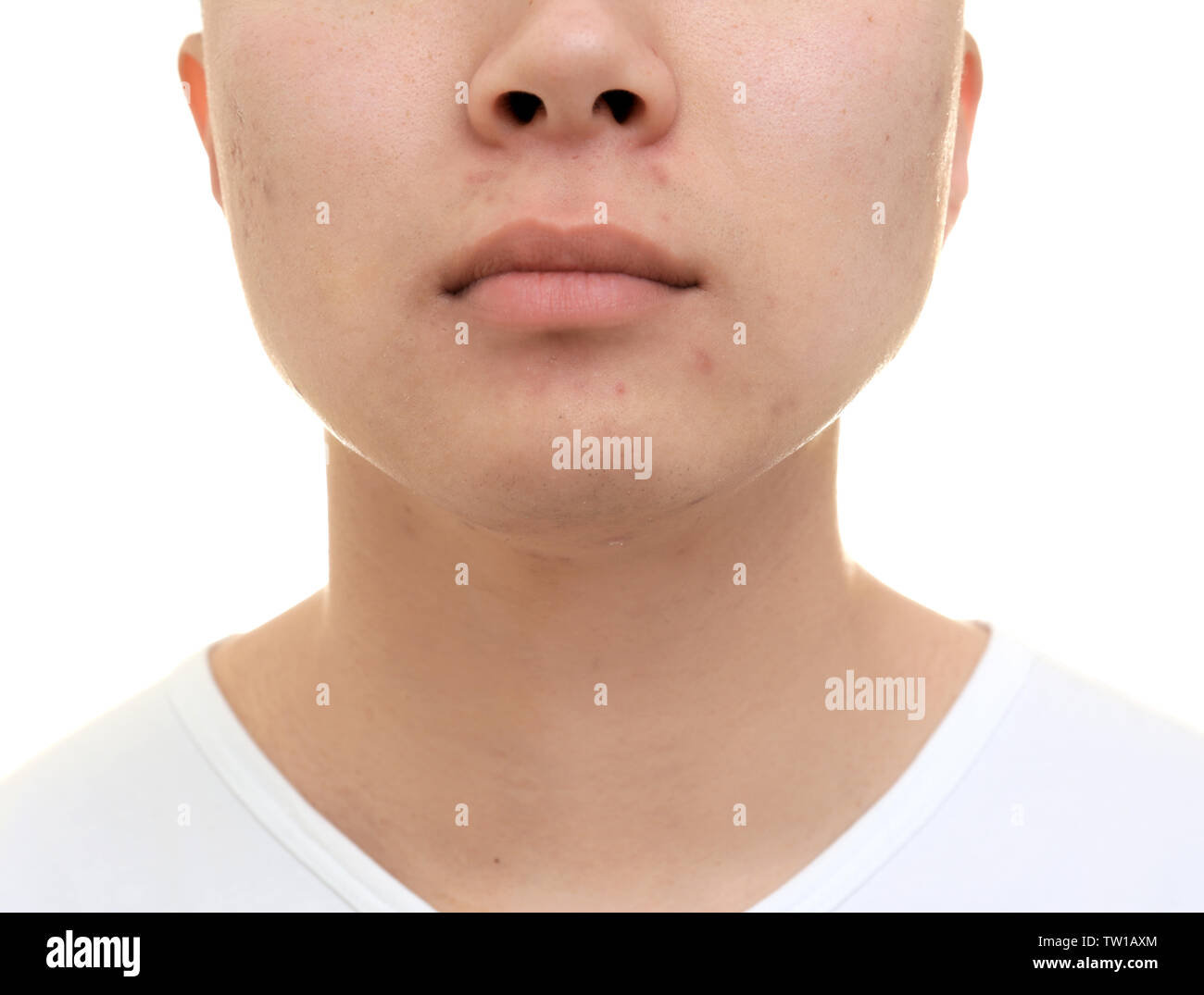 Handsome young man with problem skin on white background, closeup Stock ...