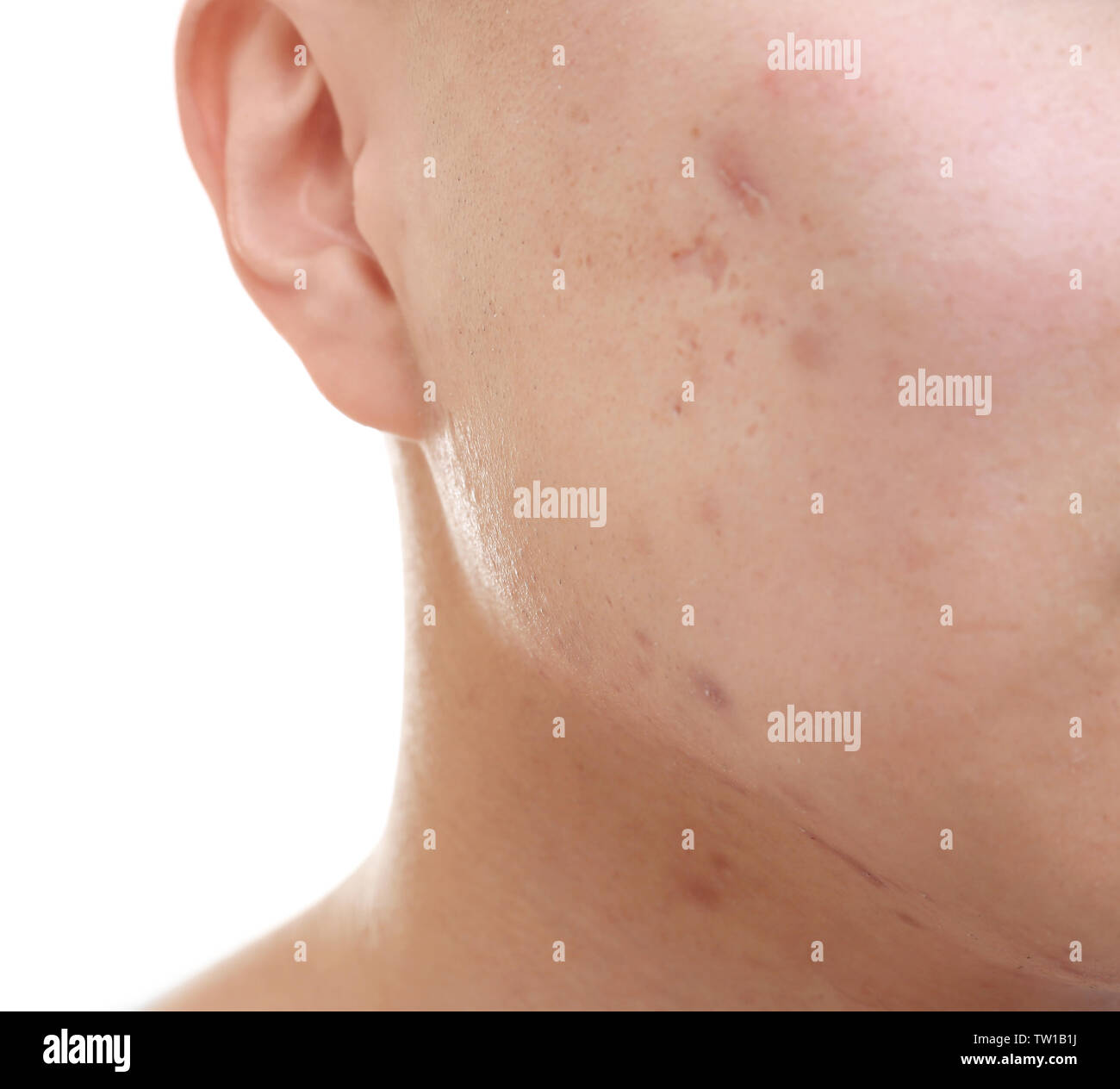 White spots on cheek hi-res stock photography and images - Alamy