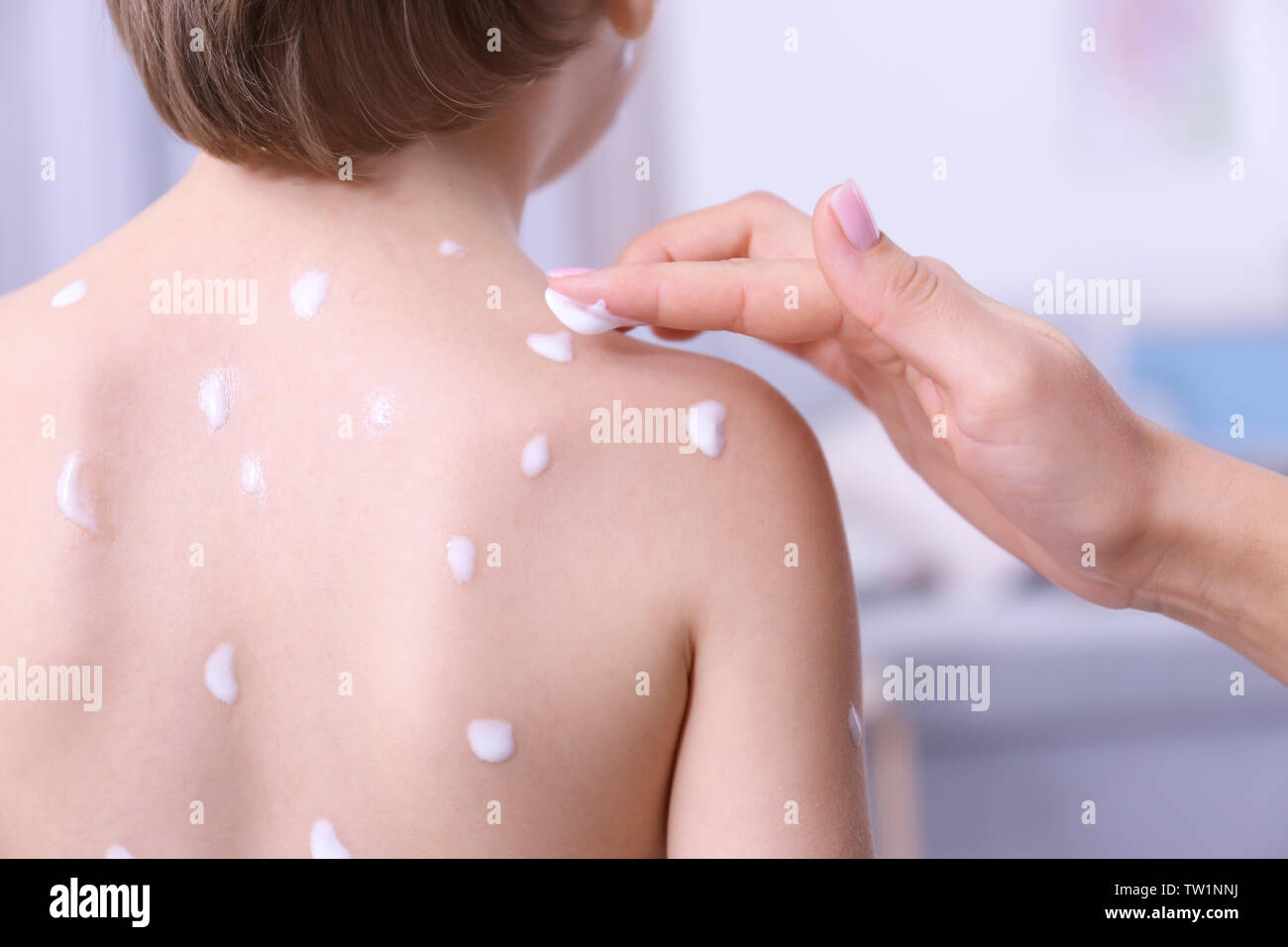 Woman applying cream onto skin of child ill with chickenpox, closeup ...