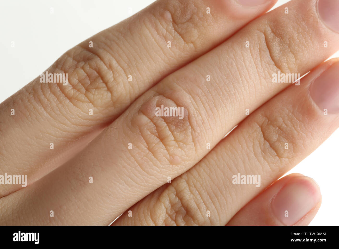 Melanoma lesions hi-res stock photography and images - Alamy