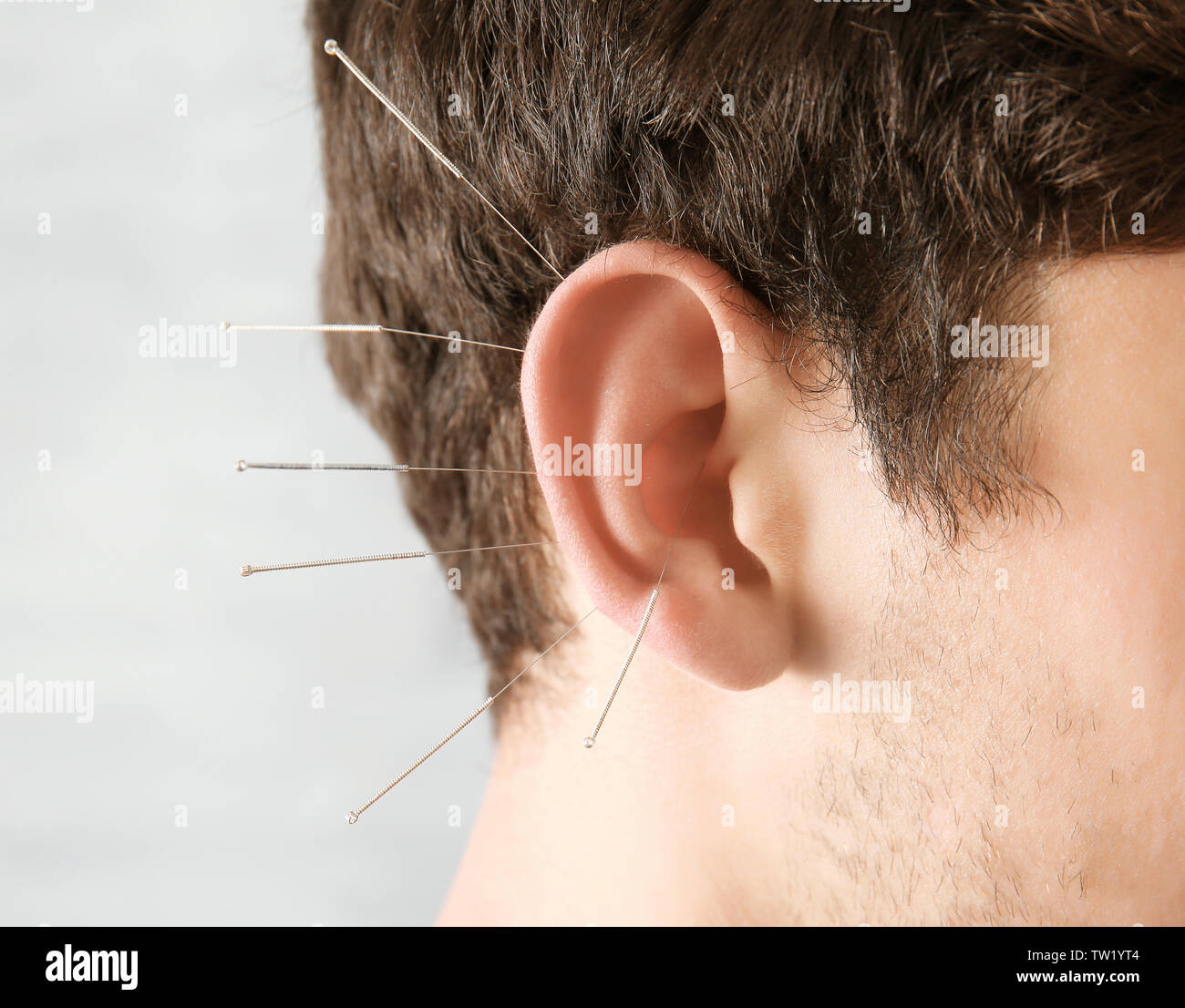 Man's ear with needles, closeup. Acupuncture concept Stock Photo - Alamy