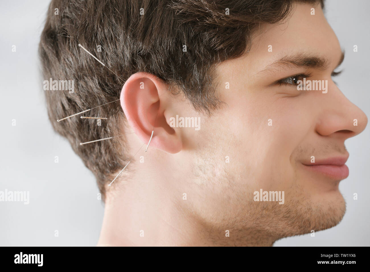 Handsome man at acupuncture treatment Stock Photo - Alamy