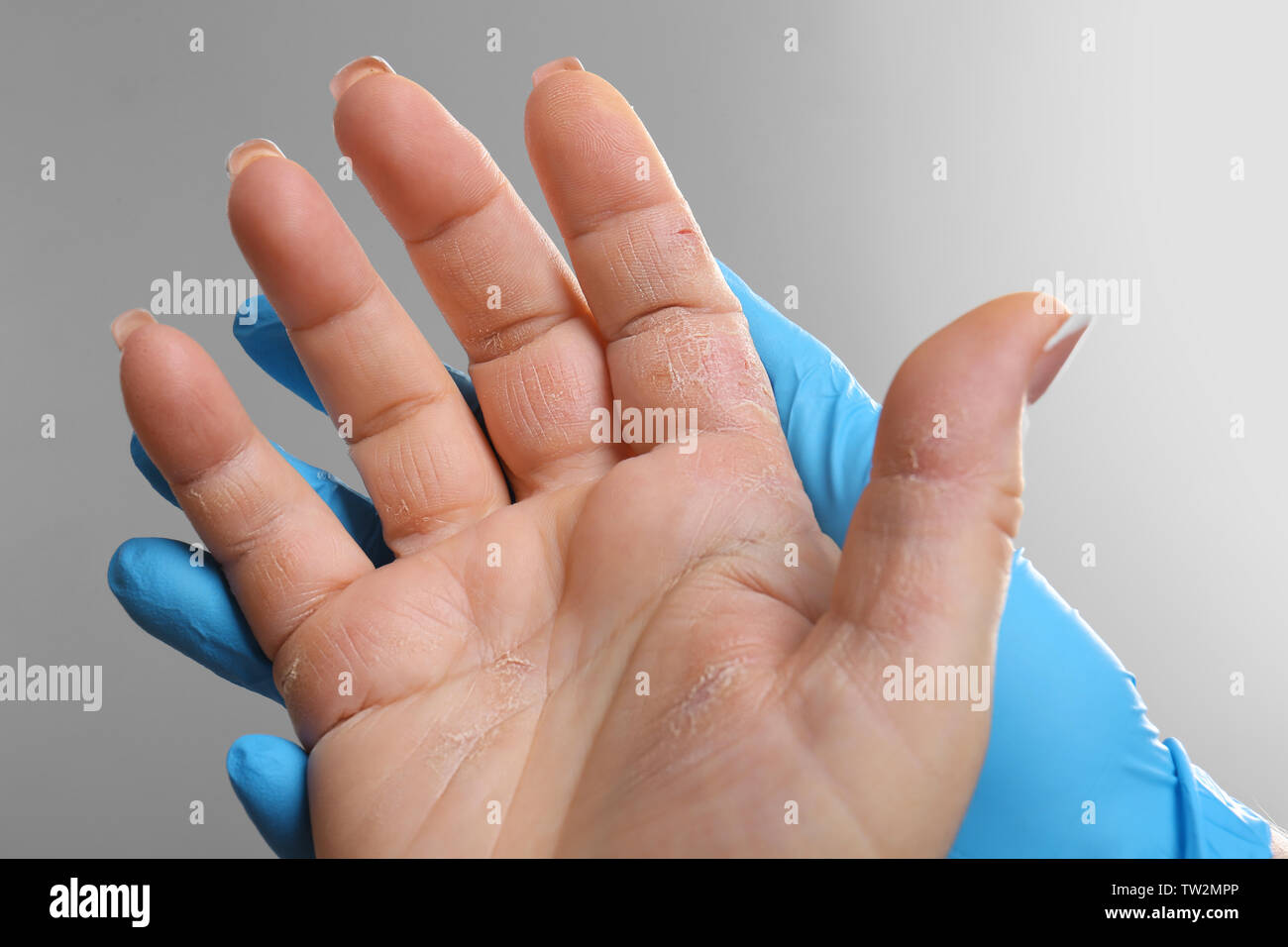 Contact dermatitis hands hi-res stock photography and images - Alamy