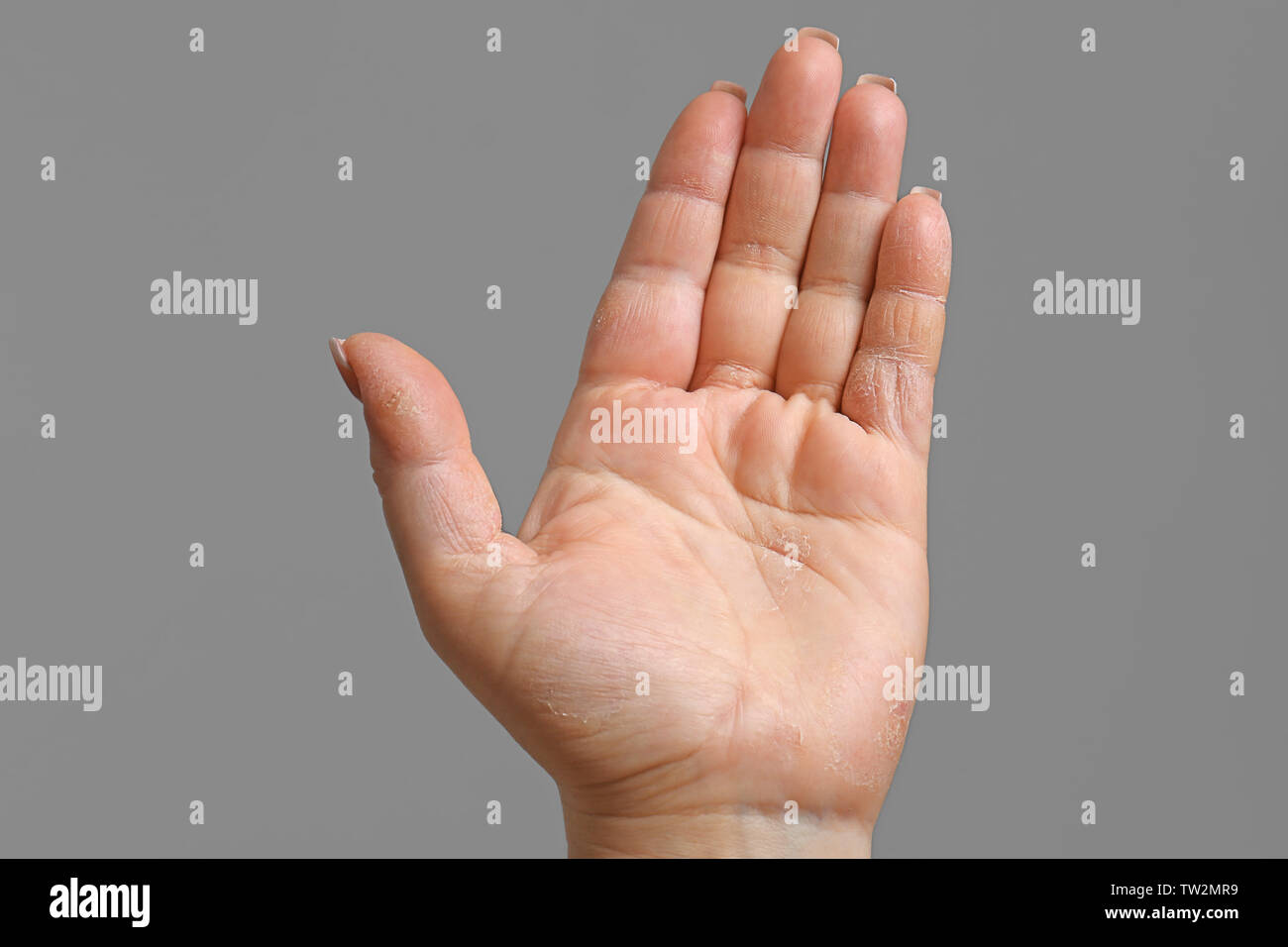 Female hand with dermatitis on gray background Stock Photo - Alamy