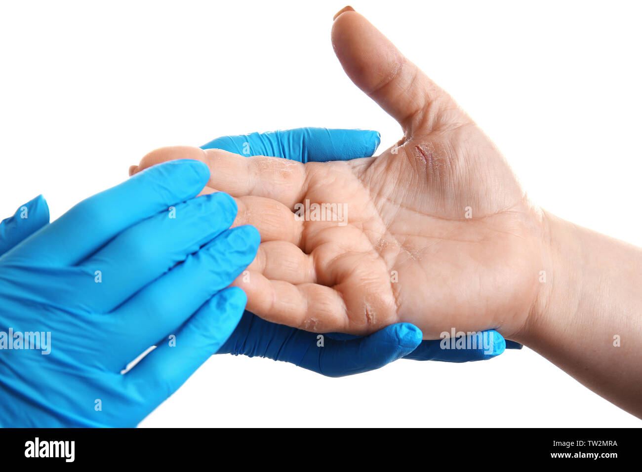 Doctor examining patient with dermatitis on hand, closeup Stock Photo ...