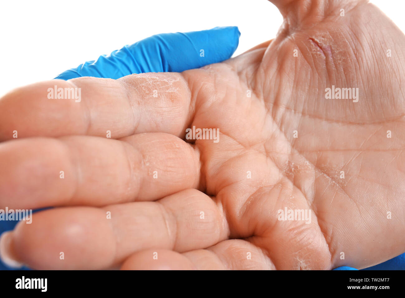 Contact dermatitis hands hi-res stock photography and images - Alamy