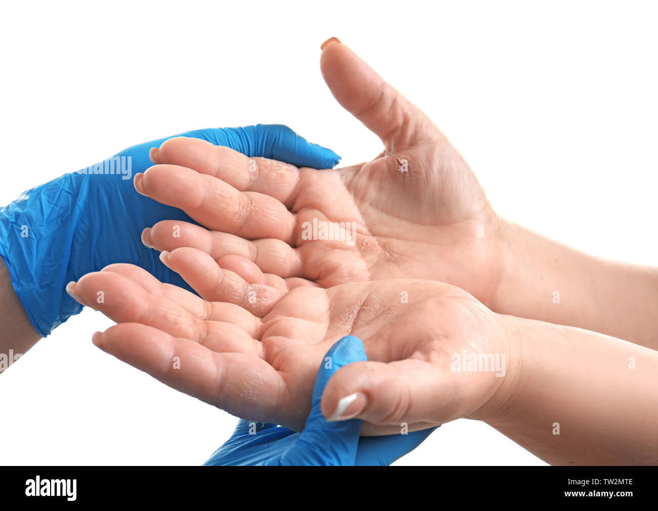 Doctor examining patient with dermatitis on hands, closeup Stock Photo ...