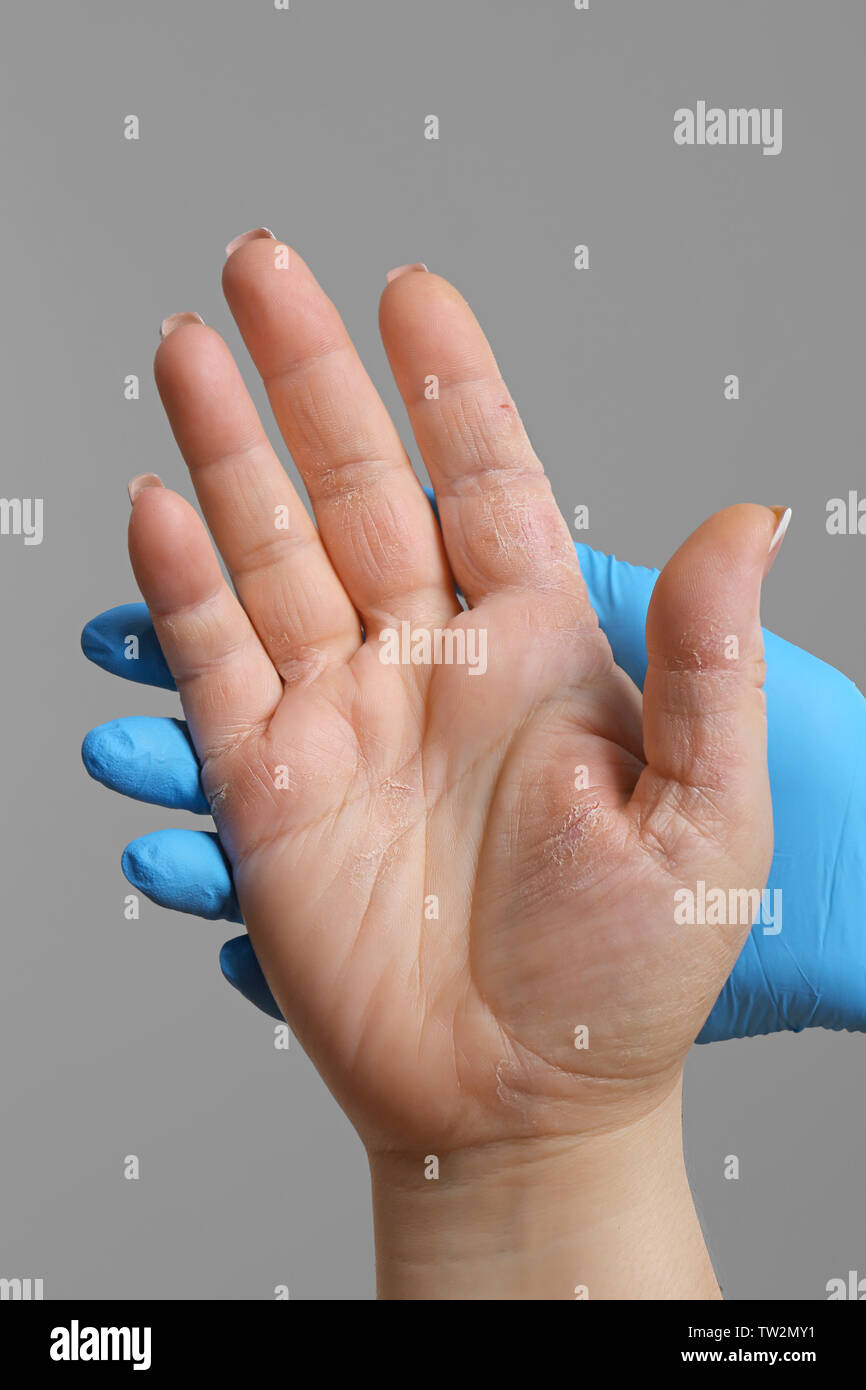 Contact dermatitis hands hi-res stock photography and images - Alamy