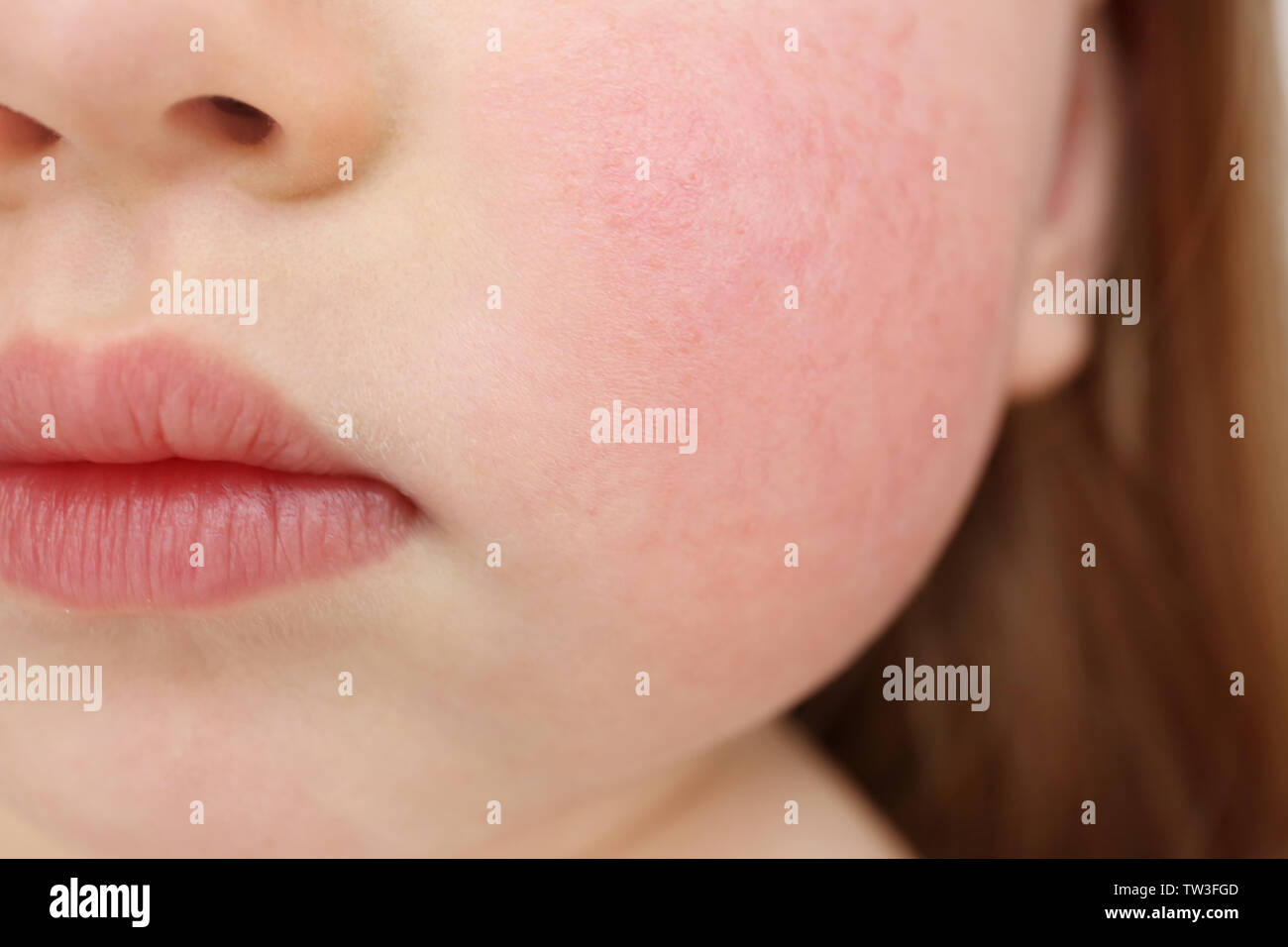 Little child with diathesis symptoms on cheeks, closeup Stock Photo - Alamy
