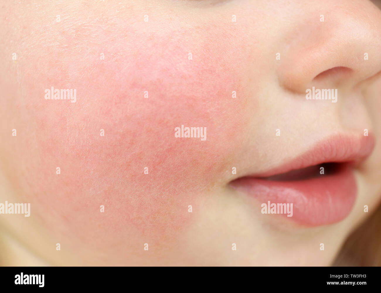 Little child with diathesis symptoms on cheeks, closeup Stock Photo - Alamy