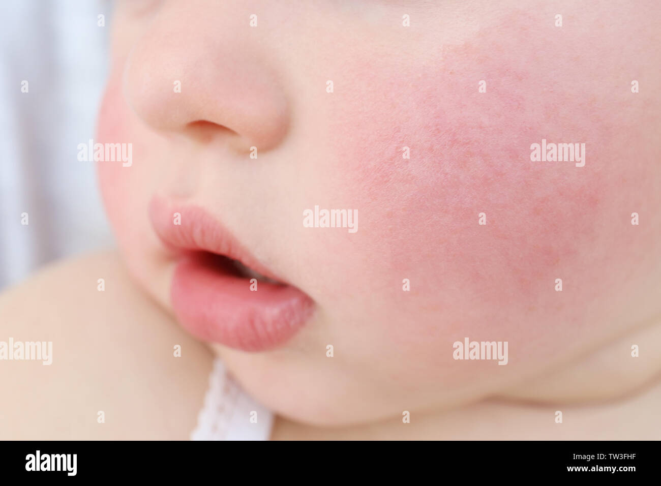Little child with diathesis symptoms on cheeks, closeup Stock Photo - Alamy