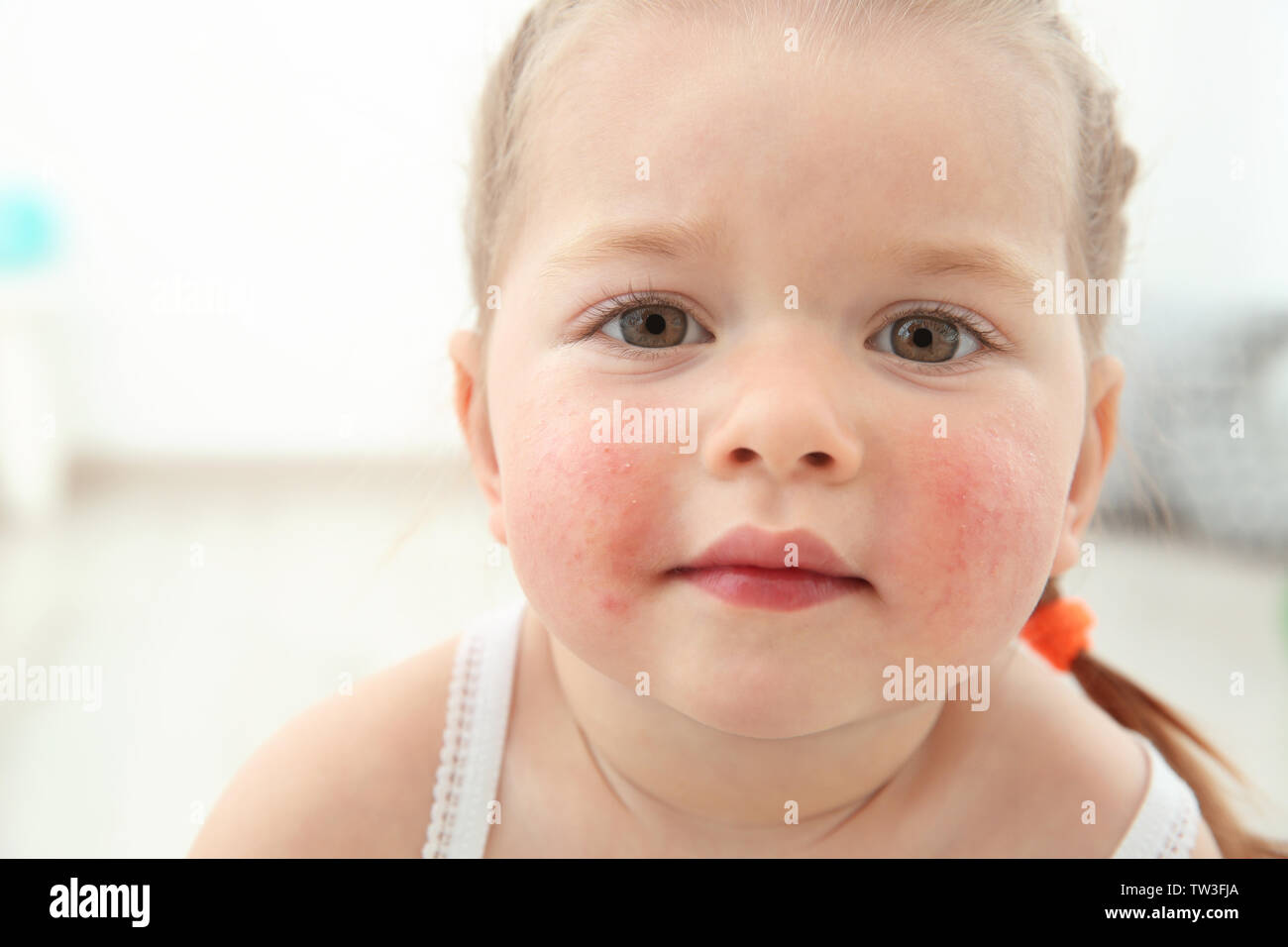 Portrait of little girl with diathesis symptoms in light room Stock ...