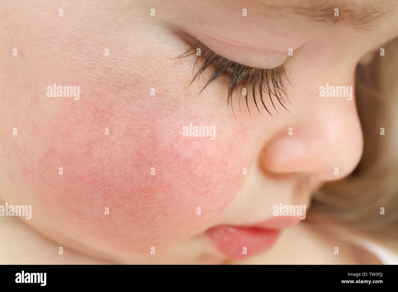 Little child with diathesis symptoms on cheeks, closeup Stock Photo - Alamy