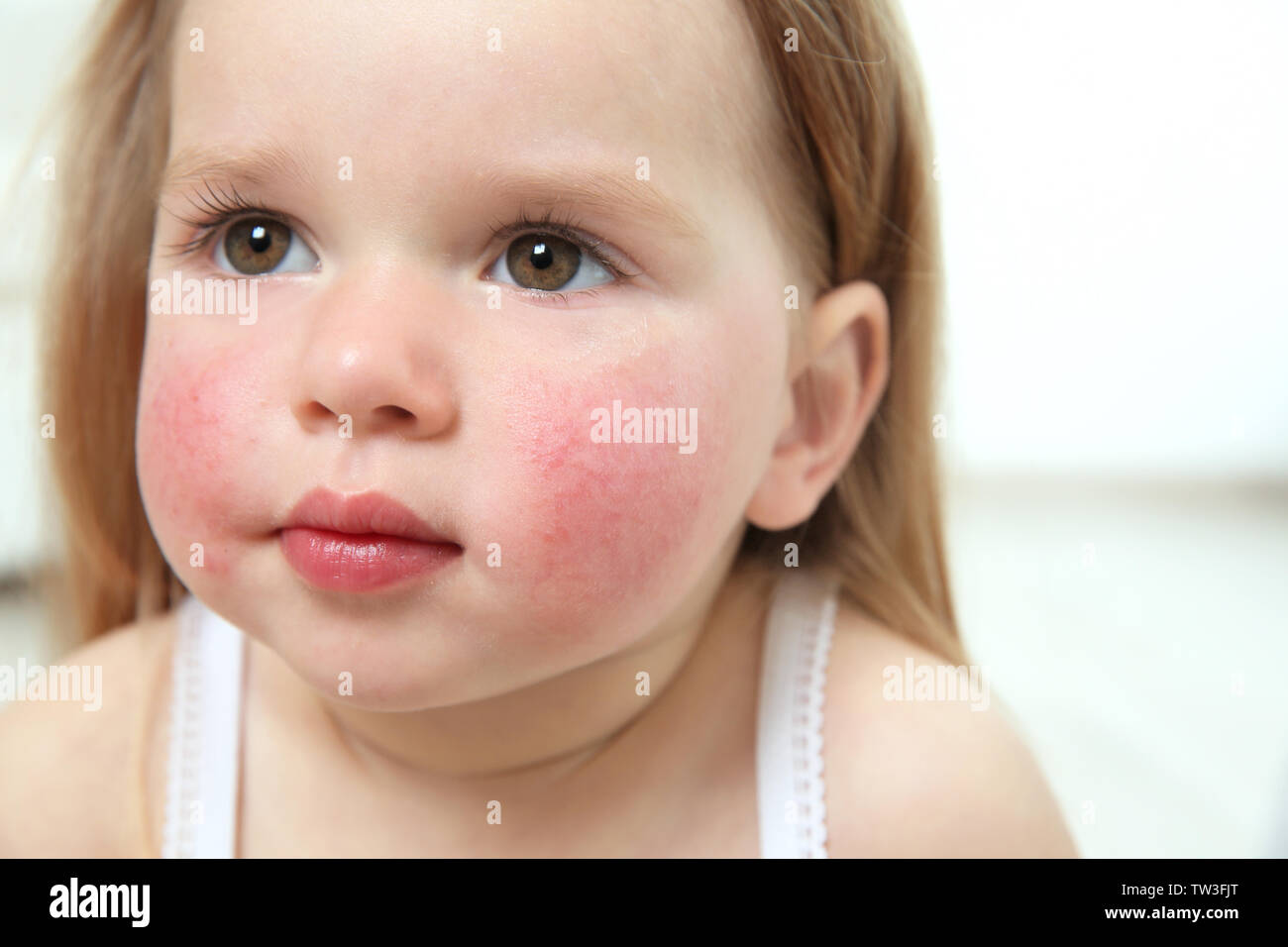 Portrait of little girl with diathesis symptoms on cheeks in light room ...