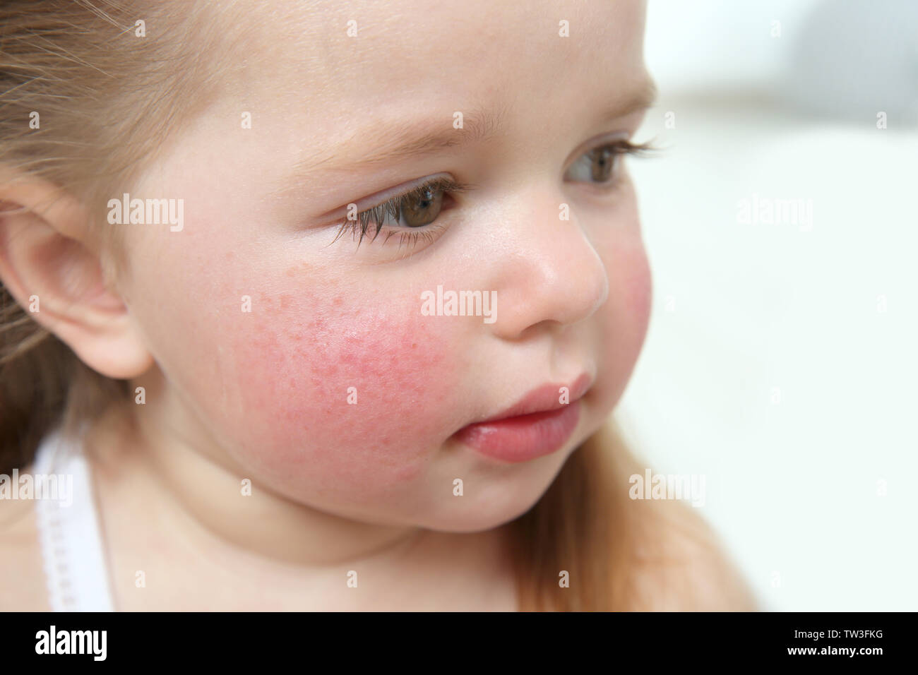 Portrait of little girl with diathesis symptoms on cheeks, closeup ...