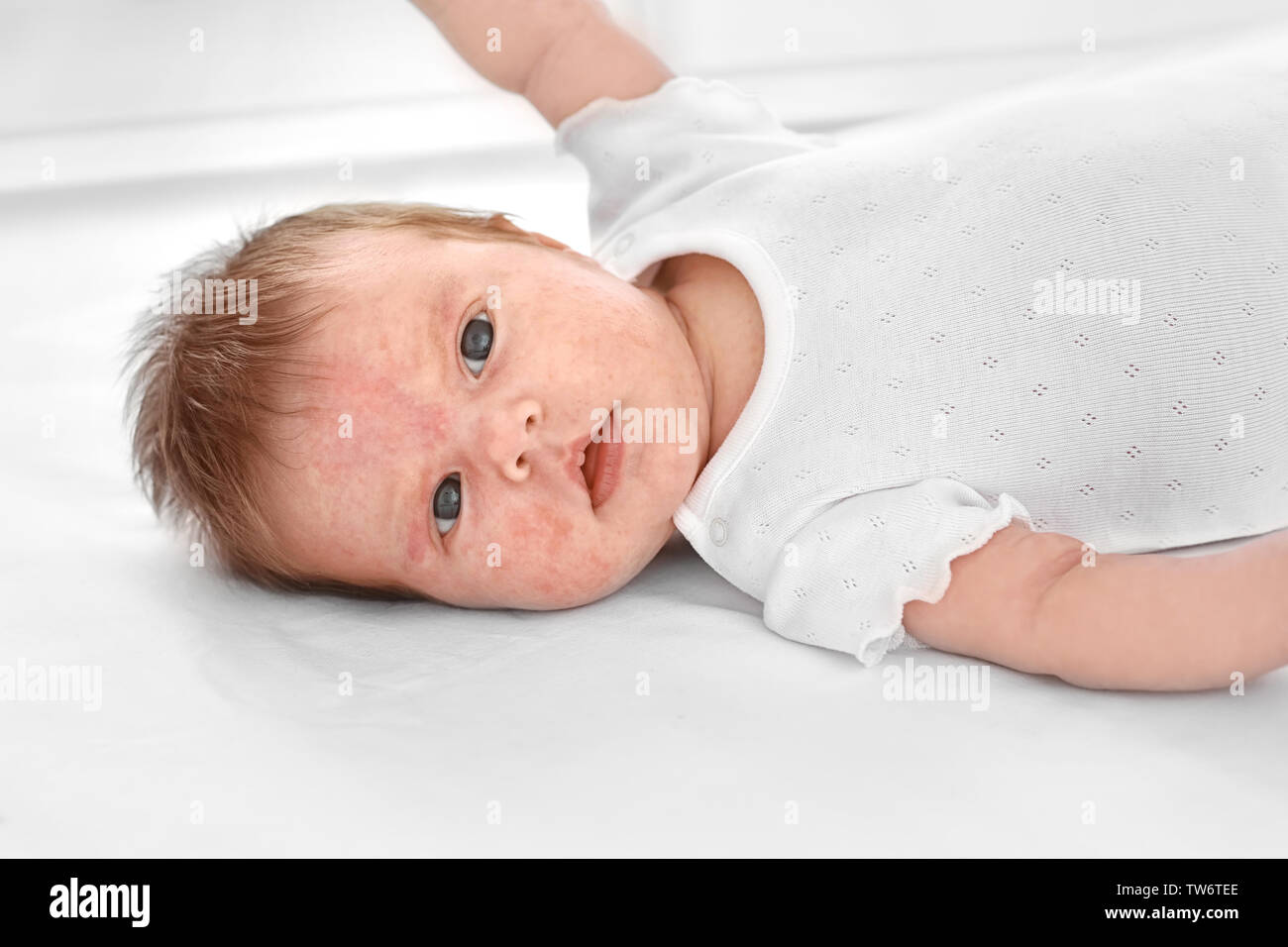 Adorable baby with skin allergy on light background Stock Photo - Alamy