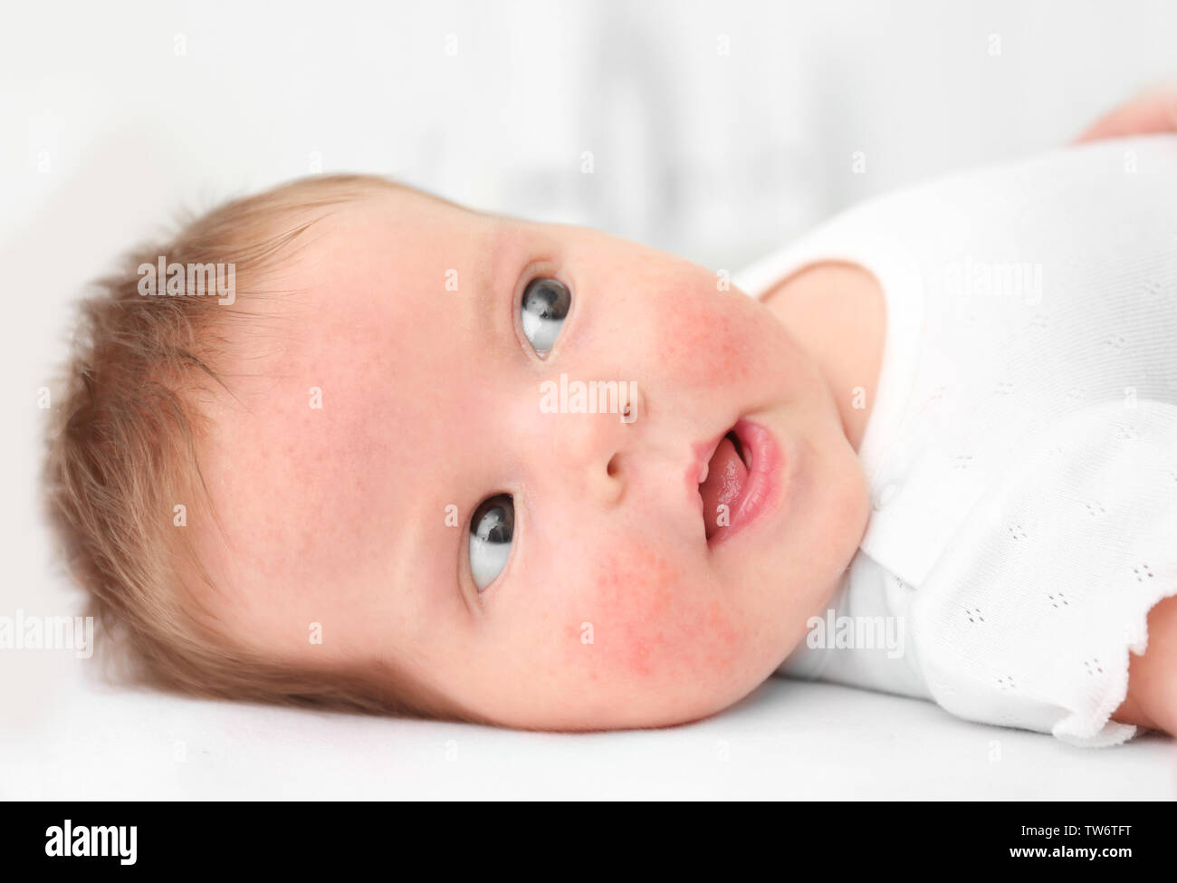 Adorable baby with skin allergy on light background Stock Photo - Alamy