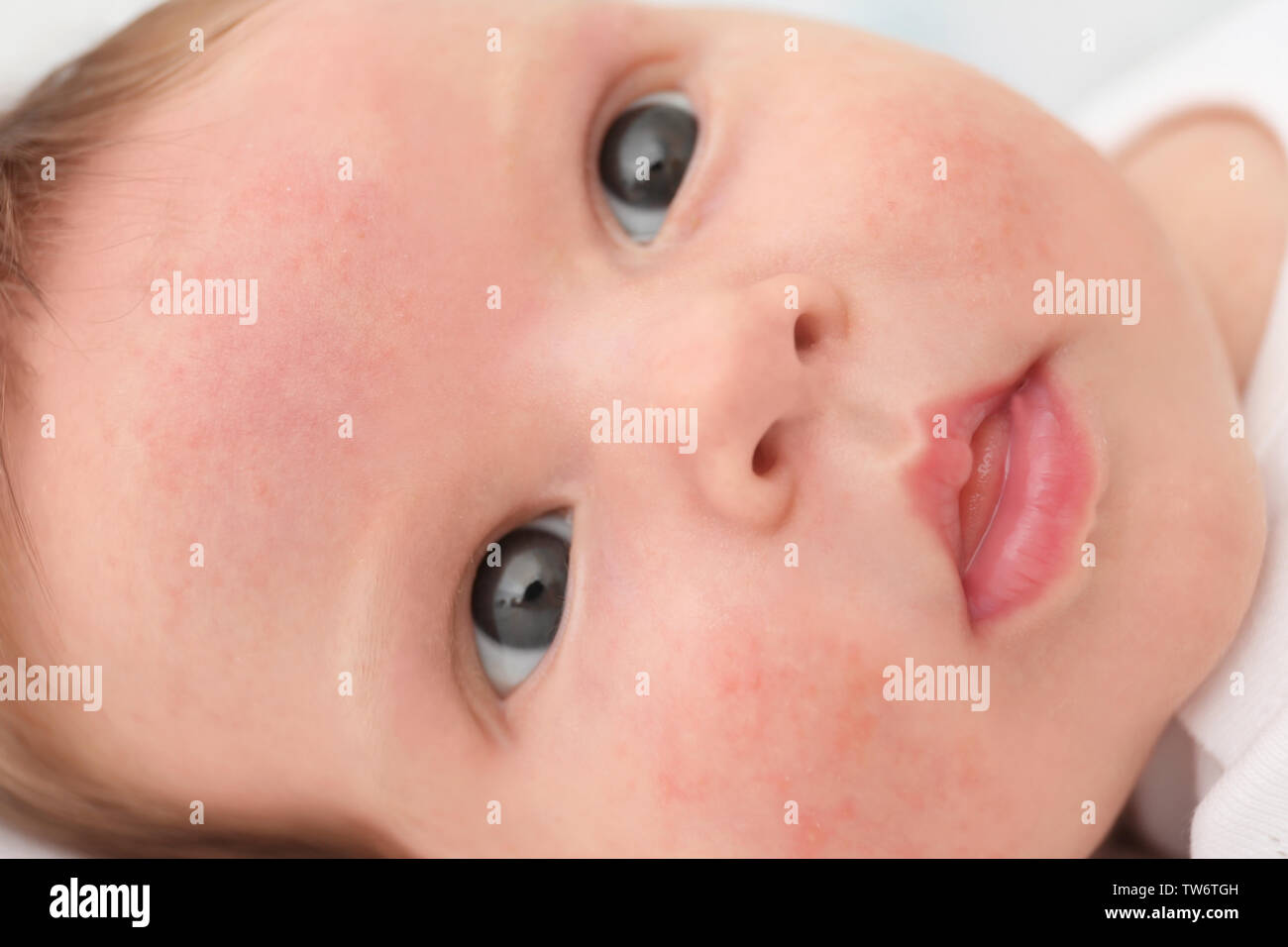 Skin Allergy High Resolution Stock Photography and Images - Alamy