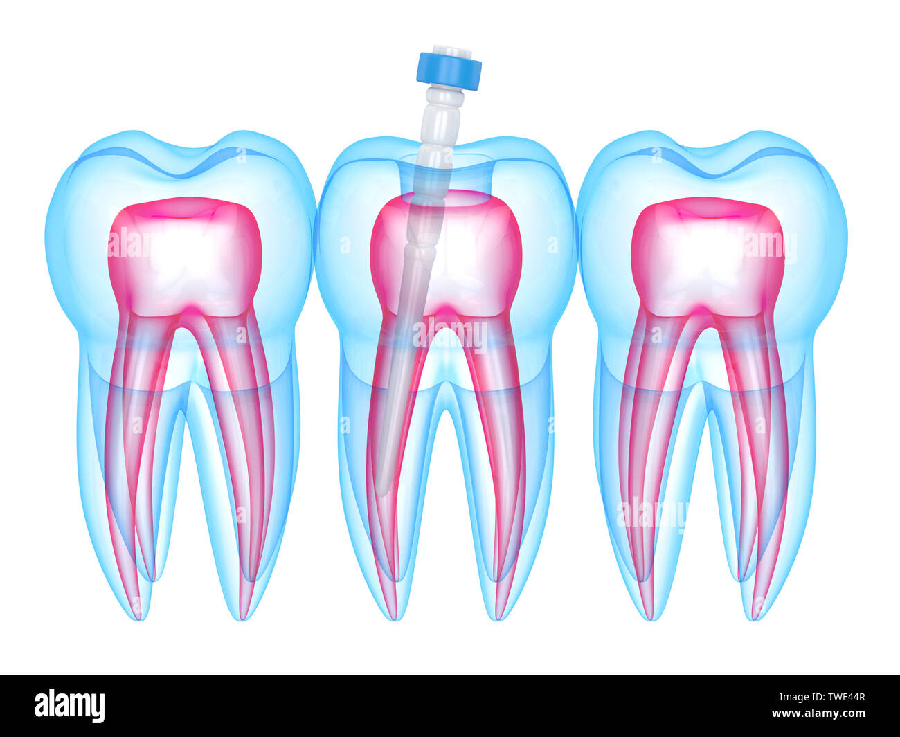 Periodontal fiber hi-res stock photography and images - Alamy