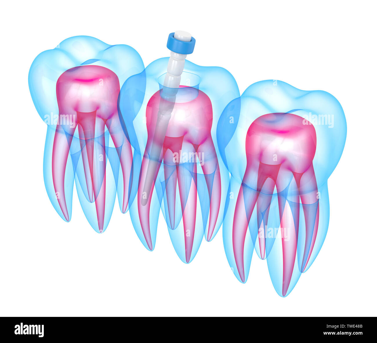 3d render of teeth with fiber post over white background Stock Photo ...