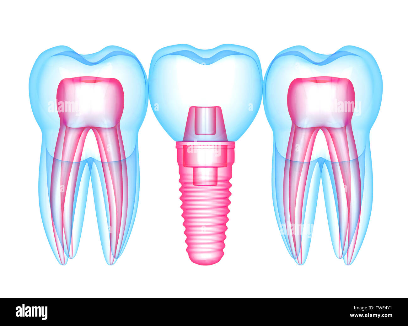 Dental Implant Wallpaper