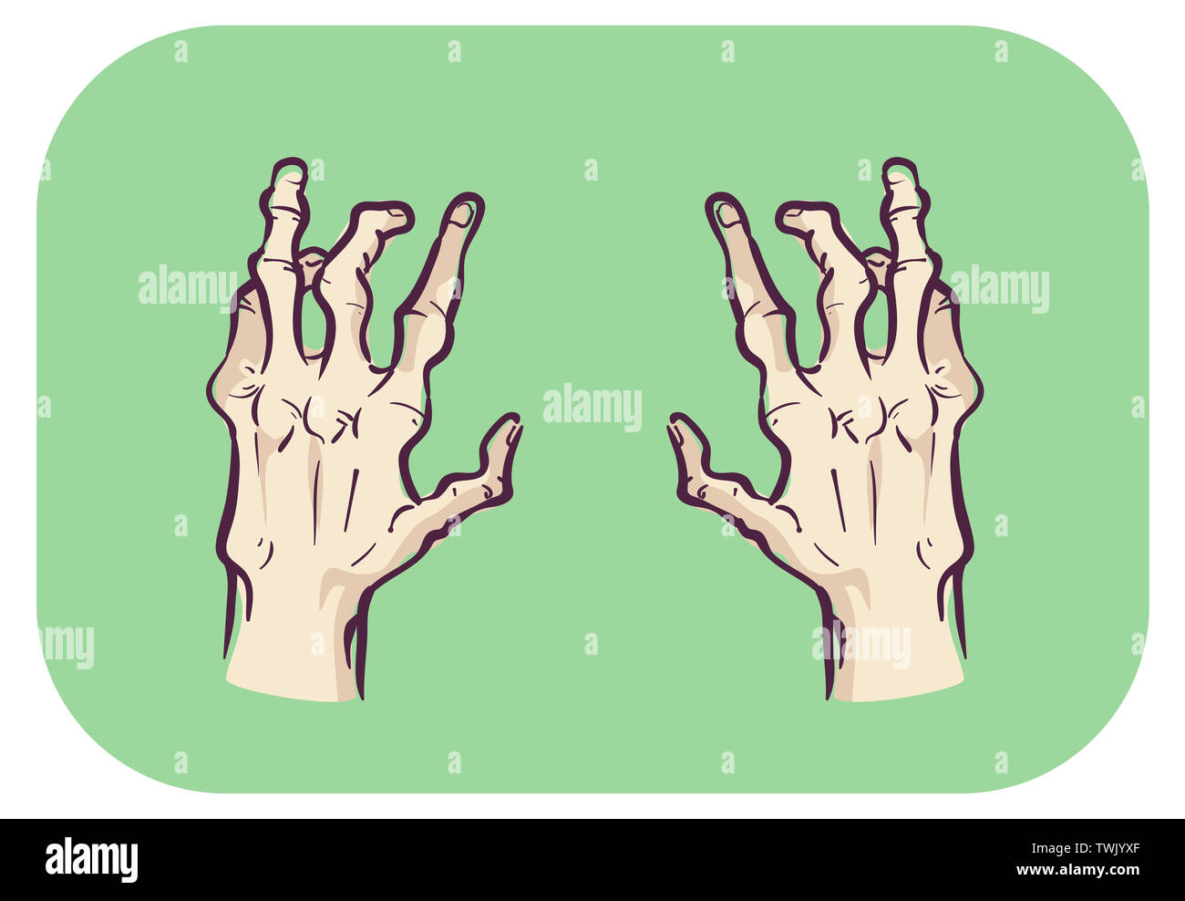 Illustration of Hands with Joint Deformity Affecting Both Hands Stock ...