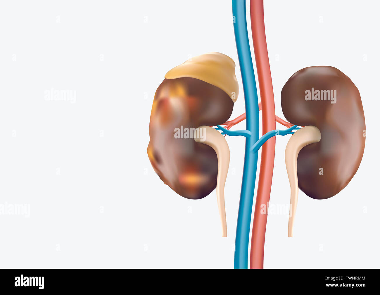 Human Kidney presents a medical concept as a organ that has the ...