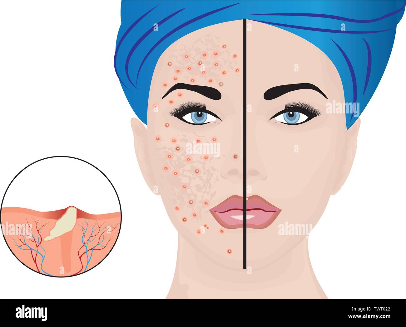 Acne pustules on a woman face and a treatment result before and after ...