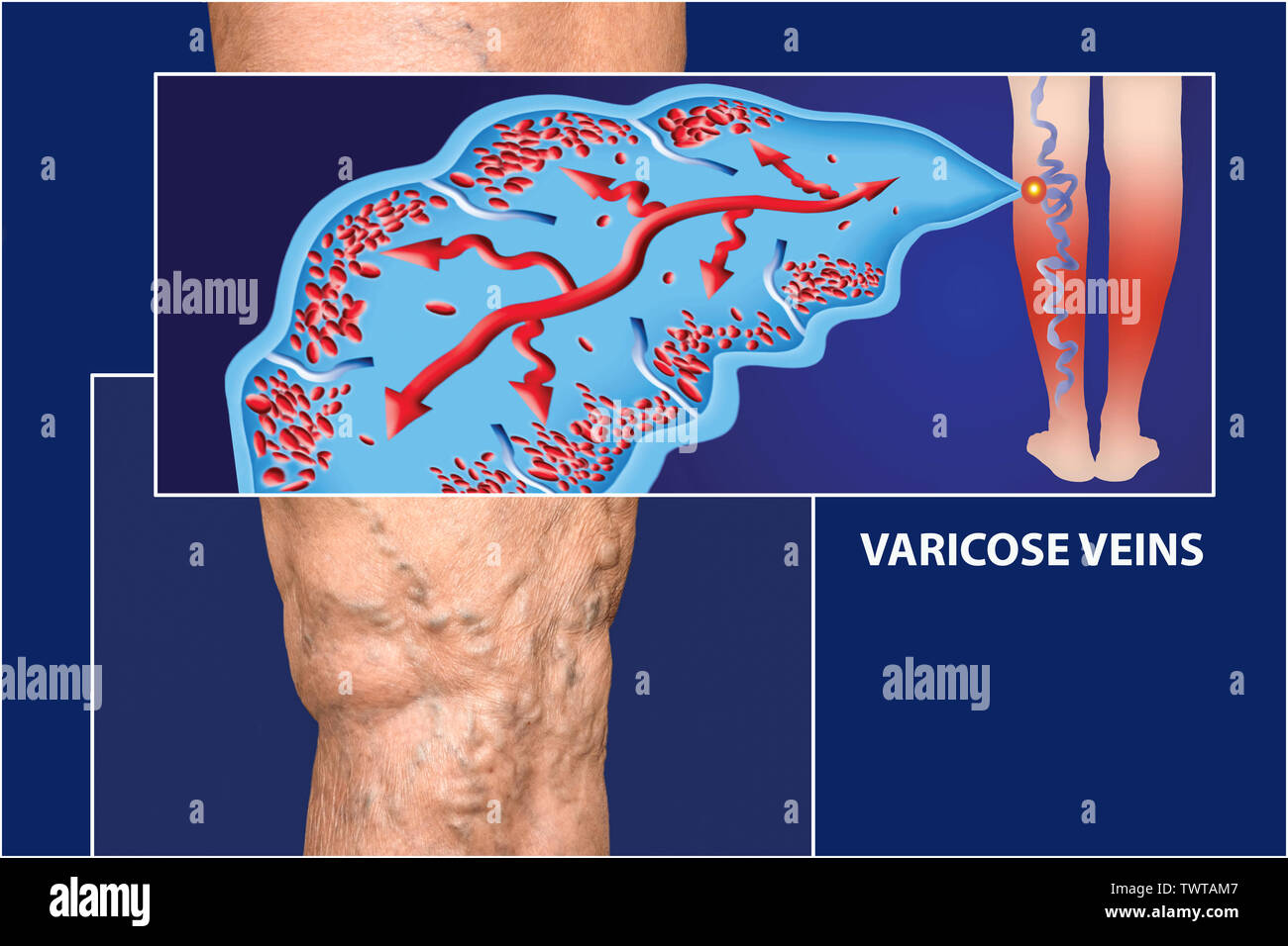 The varicose veins on a legs of woman Stock Photo - Alamy