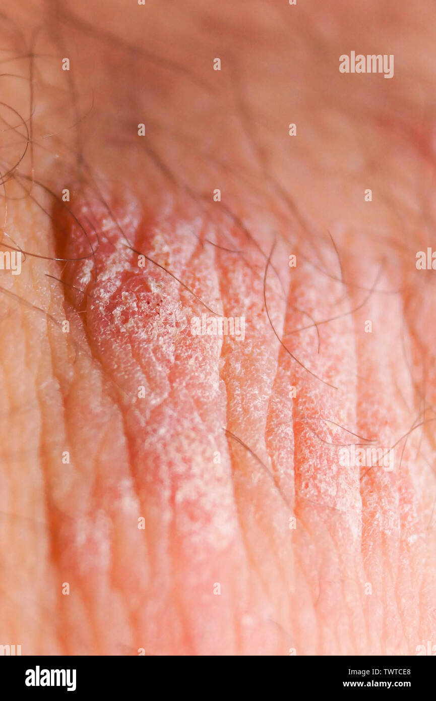 Psoriasis dry red and white irritation on the skin closeup. Image for ...