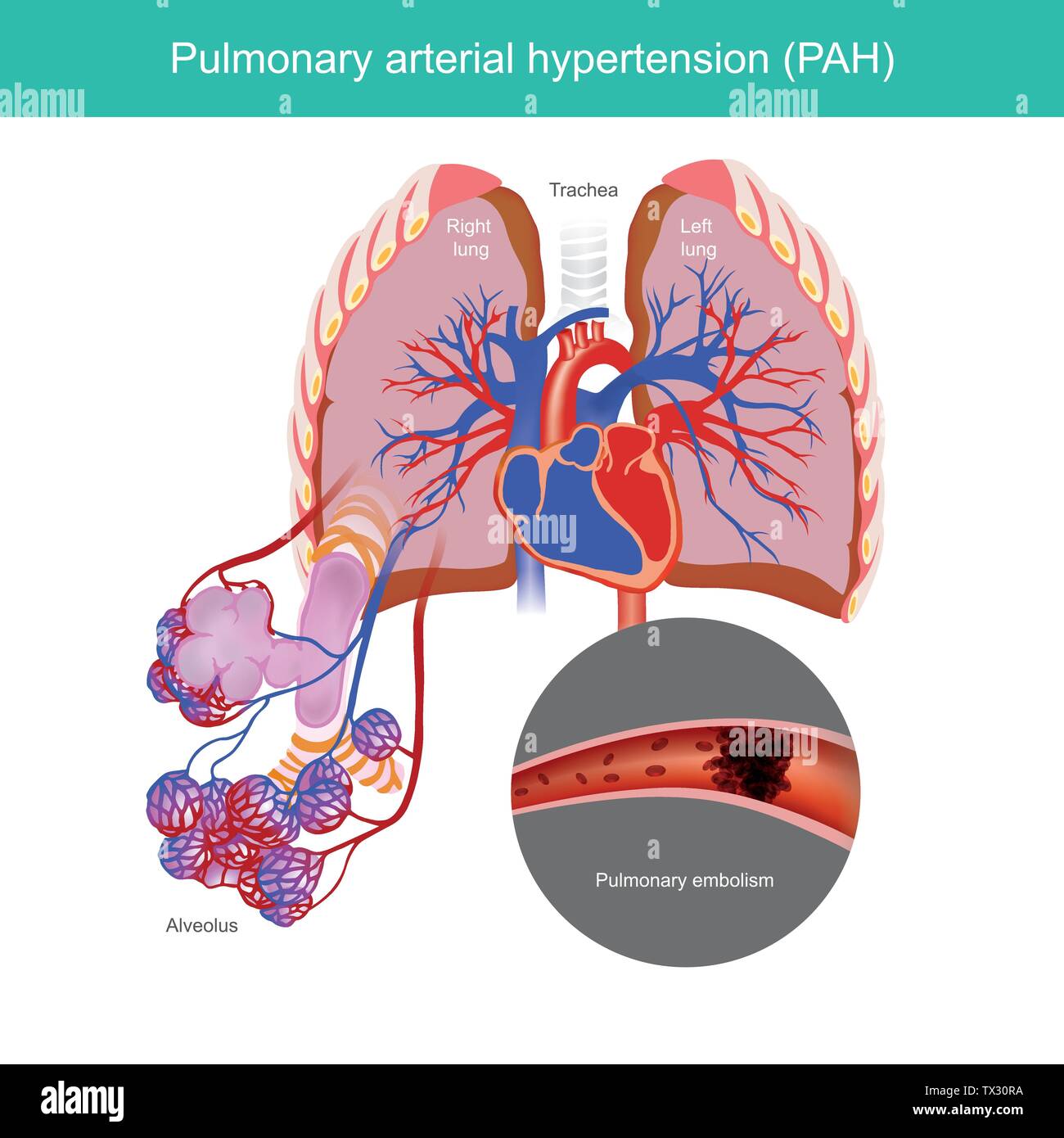 Pulmonary embolism hi-res stock photography and images - Alamy