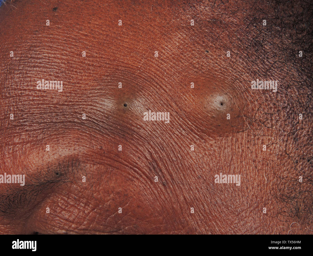 Sebaceous cysts hi-res stock photography and images - Alamy