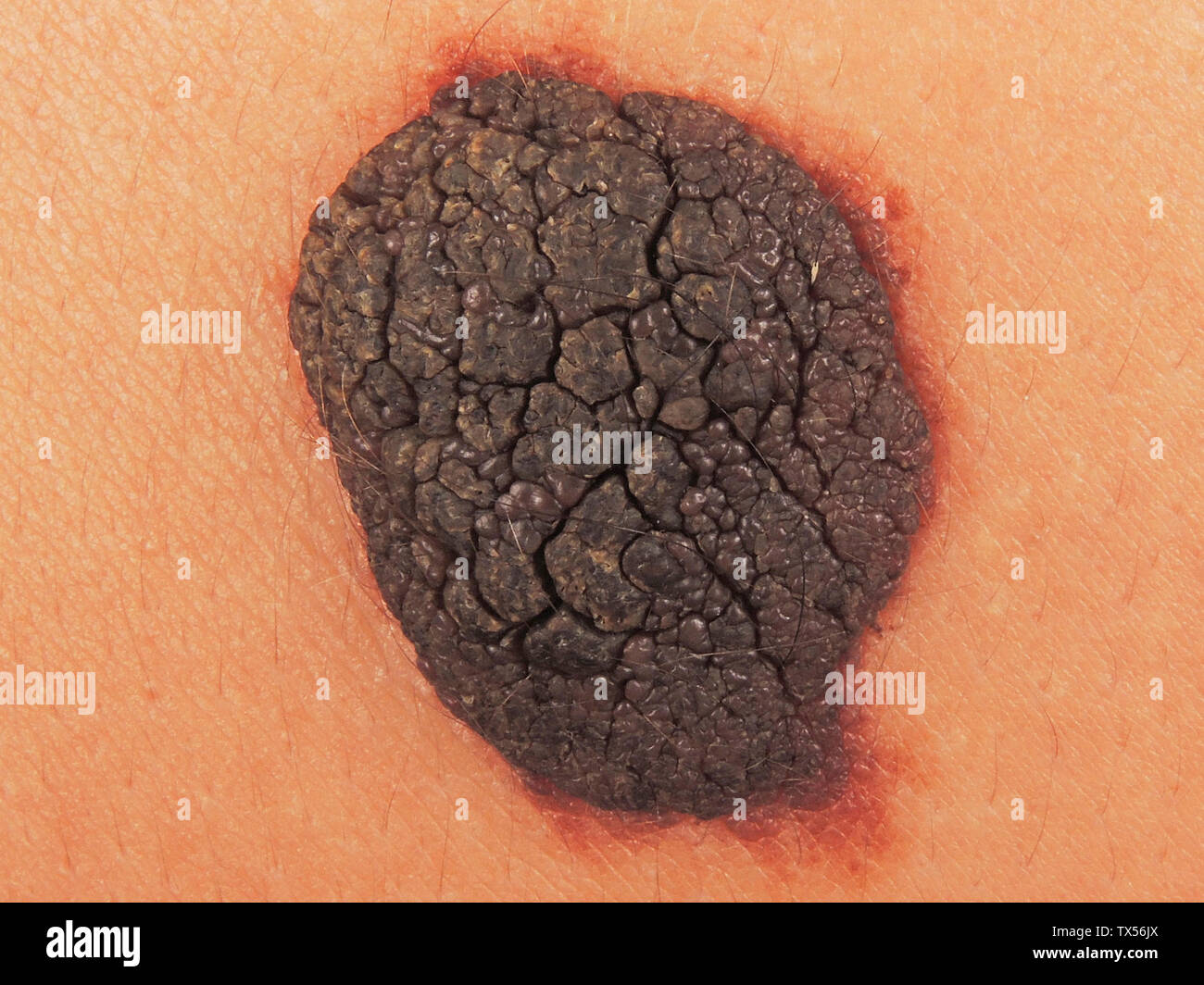 Naevus High Resolution Stock Photography and Images - Alamy