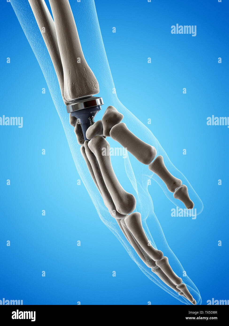 Titanium x ray hi-res stock photography and images - Alamy