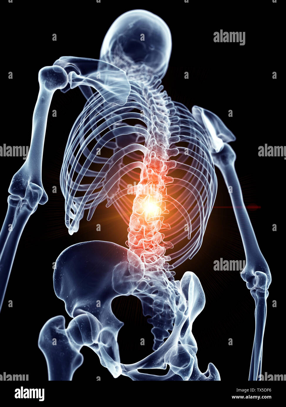 accurate medical illustration of a painful spine Stock Photo - Alamy