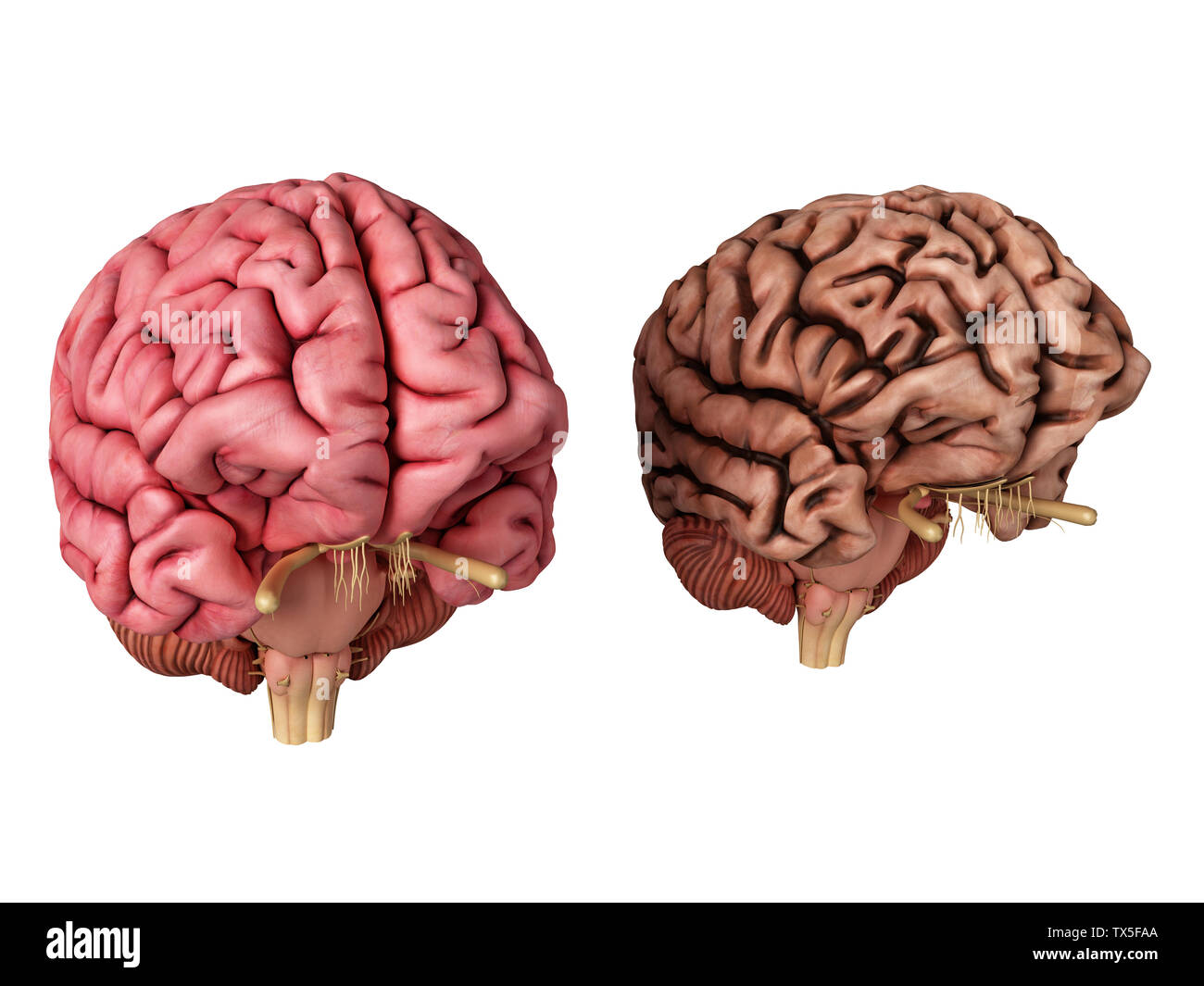 3d rendered, medically accurate illustration of a healthy and unhealthy ...